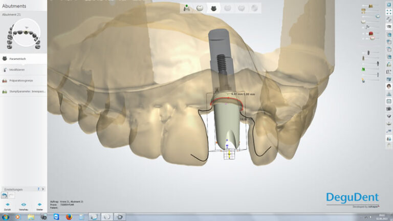 Individuelle Implantat Abutments aus Titan und Zirkon