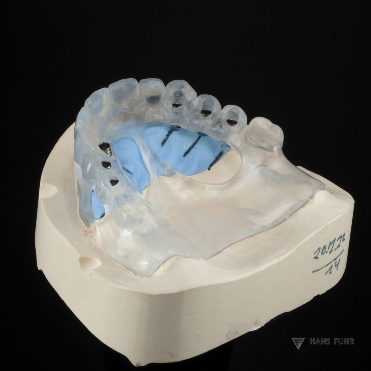 Implantat-Bohrschablone, Orientierungsschablone, analog